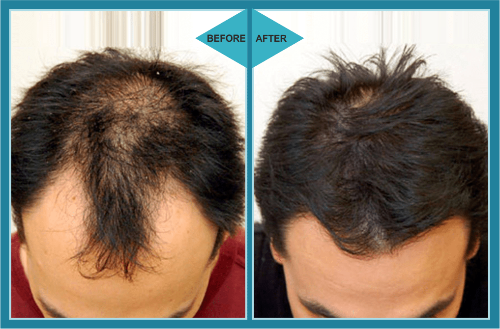 Hair-transplant - Zenith Hospital Indore