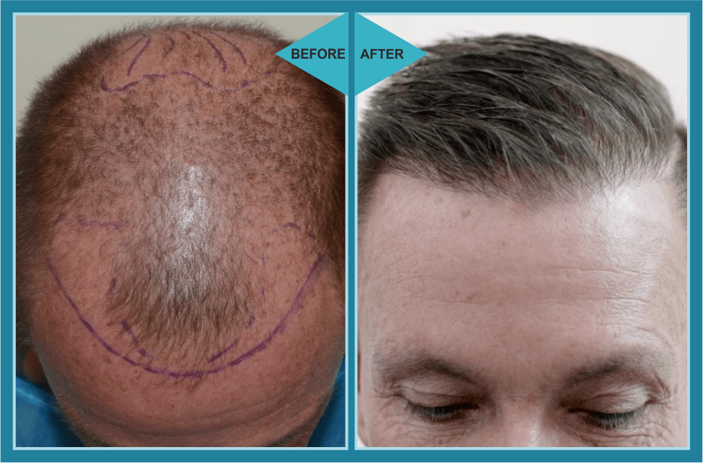 Hair-transplant - Zenith Hospital Indore