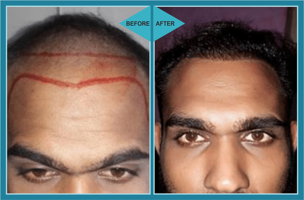 Hair-transplant - Zenith Hospital Indore