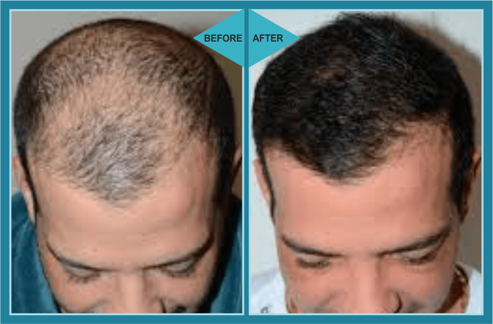Hair-transplant - Zenith Hospital Indore